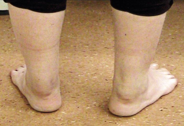 Tidig diagnos och behandling med gallsyra avgörande vid cerebrotendinös ...